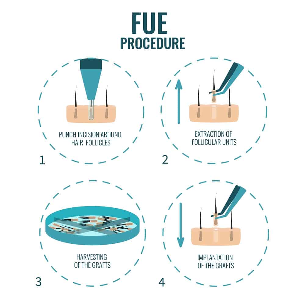 Fue Transplant Method Follicular Unit Extraction Mhtc